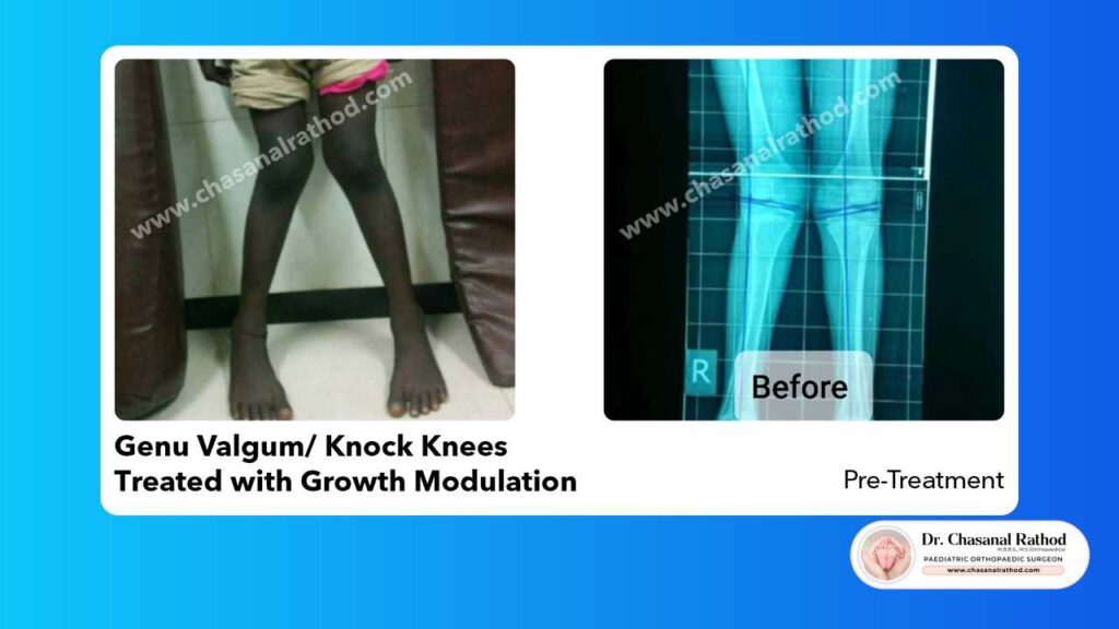 Gene Valgum / Knock Knees Treated With Growth Modulation – Dr. Chasanal ...